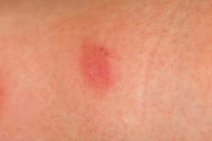 Do Palmetto Bugs Bite? | APB